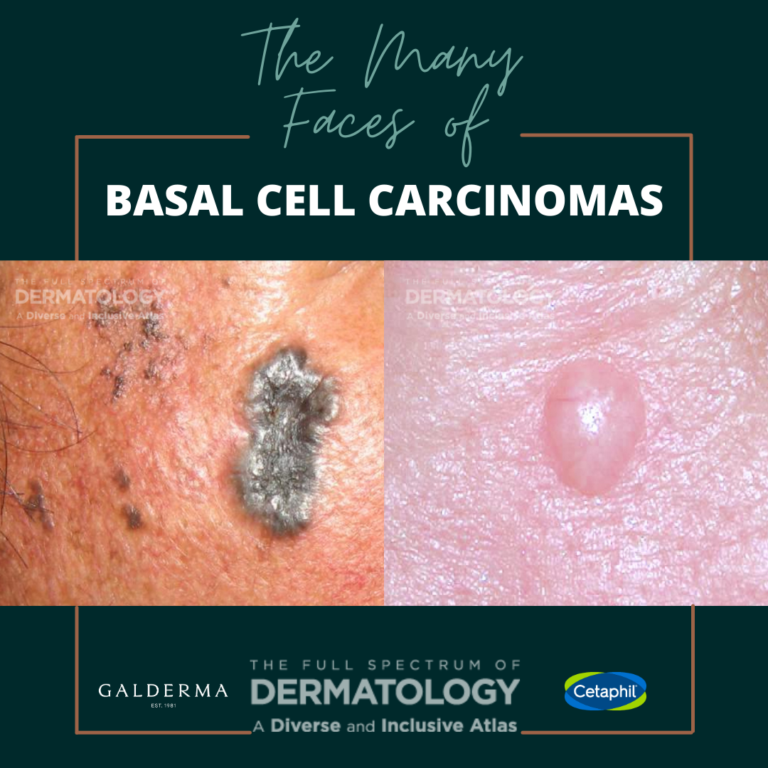 The Many Faces of Basal Cell Carcinomas (BCCs) - JDDonline - Journal of ...